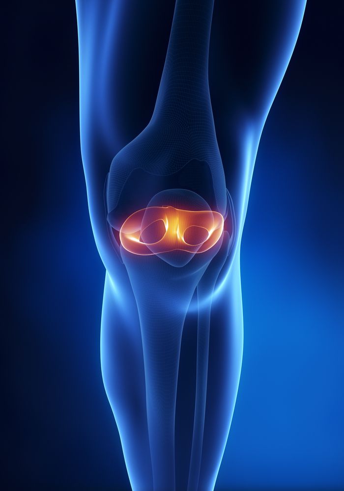 Meniscal Root Tear: Diagnosis, Treatment & Surgical Repair | Dr ...